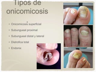 Micosis superficiales y candidiasis | PPTX