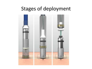 Micra™ WIRELESS Permanent pacemaker | PPTX