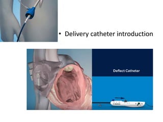 Micra™ WIRELESS Permanent pacemaker | PPTX