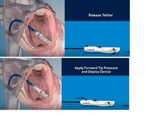 Micra™ WIRELESS Permanent pacemaker | PPTX