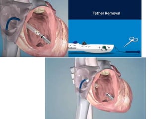 Micra™ WIRELESS Permanent pacemaker | PPTX