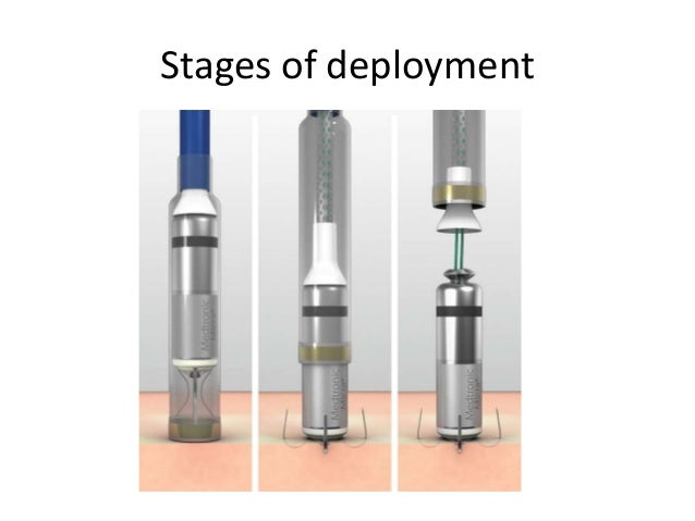 Micra™ WIRELESS Permanent pacemaker