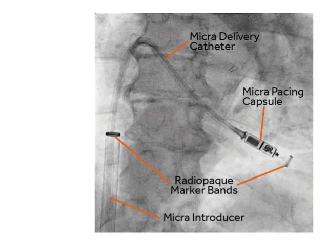 Micra™ WIRELESS Permanent pacemaker