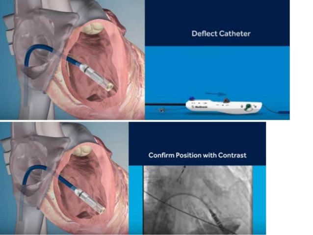 Micra™ WIRELESS Permanent pacemaker