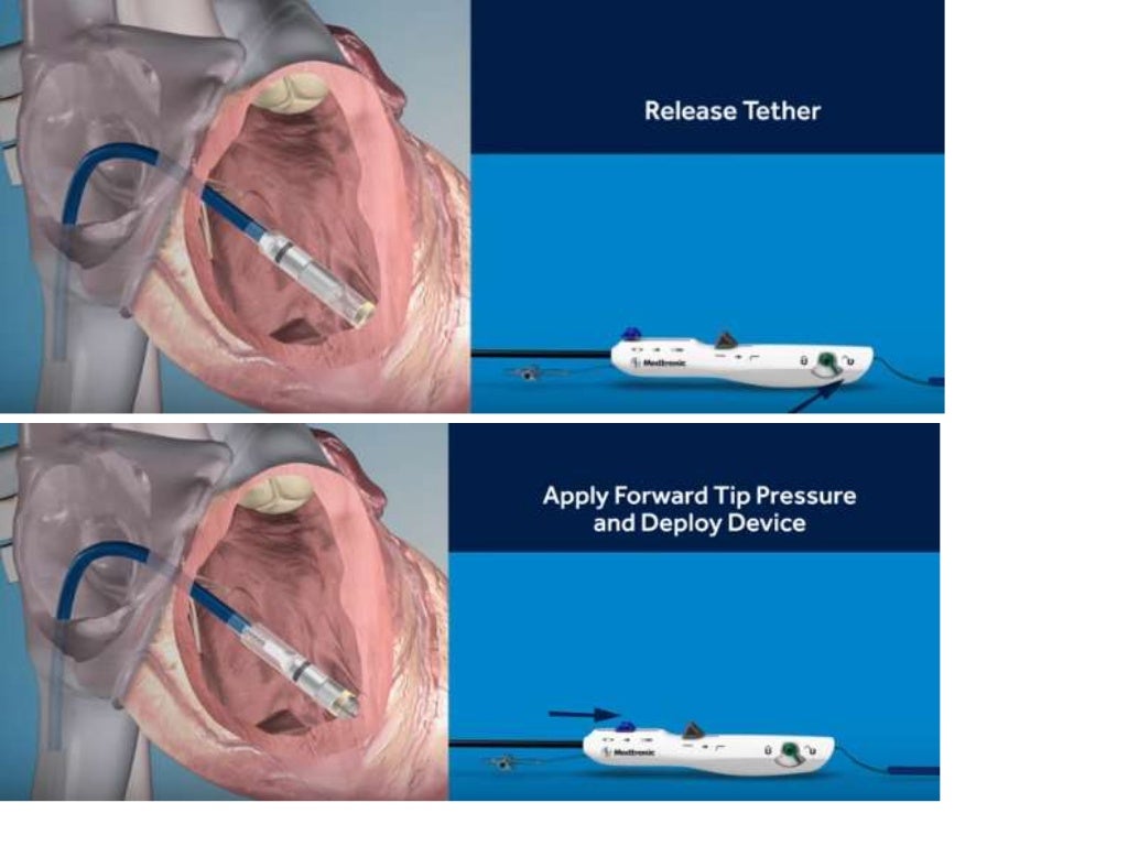 Micra™ WIRELESS Permanent pacemaker