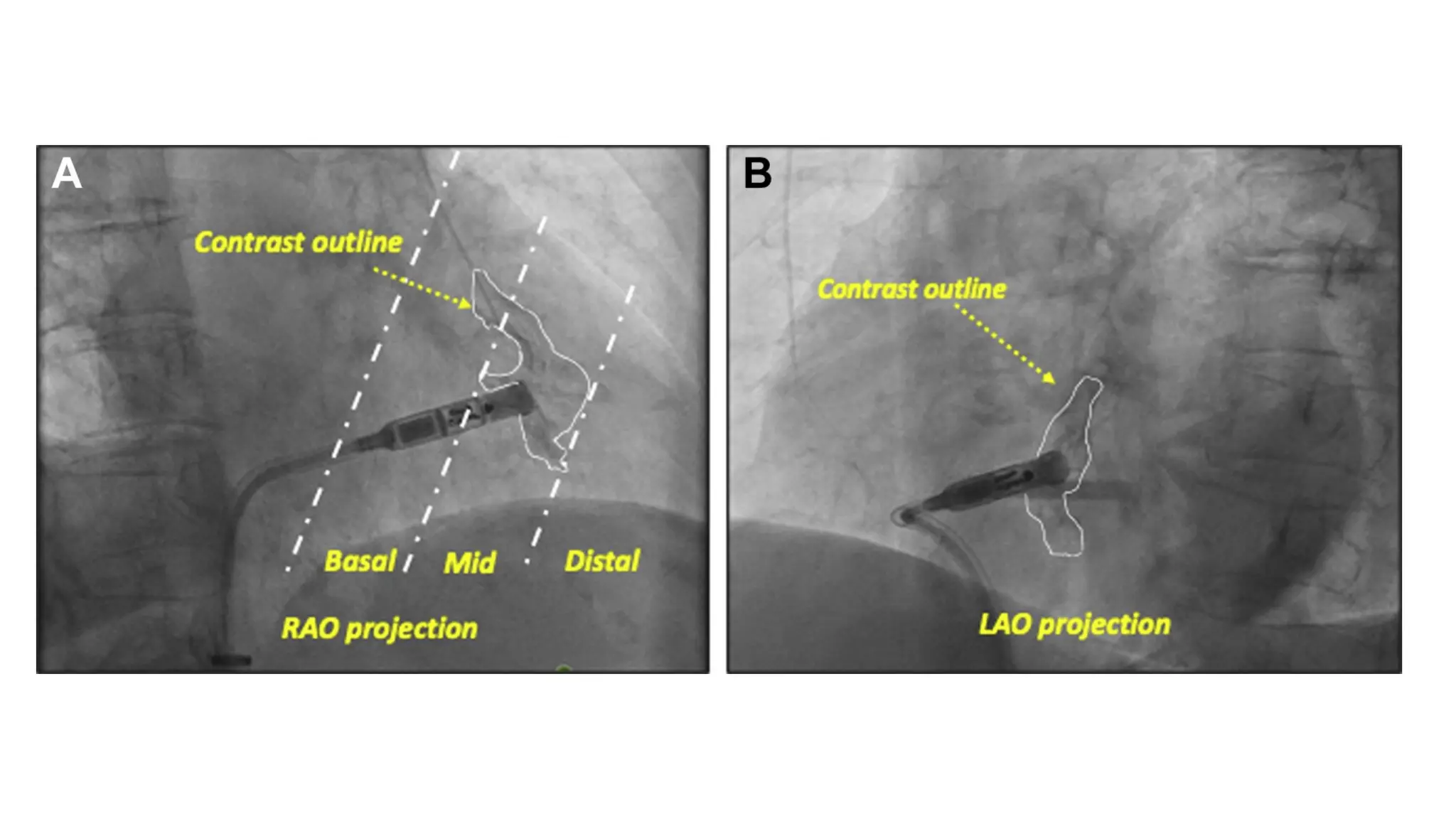 MICRA LEADLESS PACEMAKER INSERTION TECHNIQUE.pptx