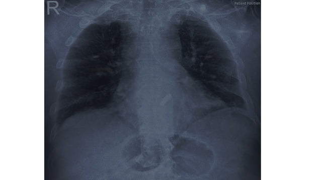 MICRA LEADLESS PACEMAKER INSERTION TECHNIQUE.pptx