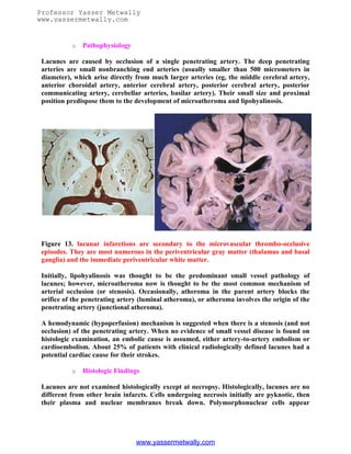 Radiological pathology of ischemic microvascular brain disease…An ...