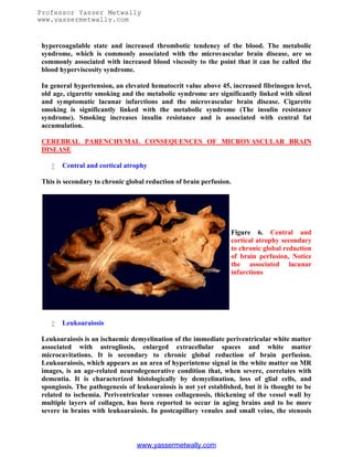 Radiological pathology of ischemic microvascular brain disease…An ...