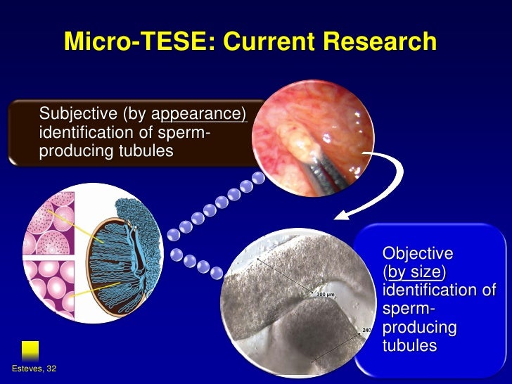 Micro-TESE as the latest option for the worst azoospermia scenarios