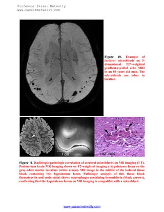 Radiological pathology of cerebral microbleeds | PDF