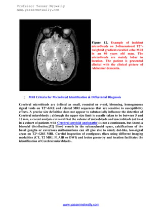 Radiological pathology of cerebral microbleeds | PDF