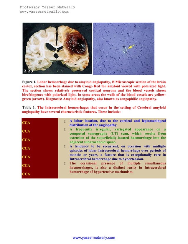 Radiological pathology of cerebral microbleeds | PDF