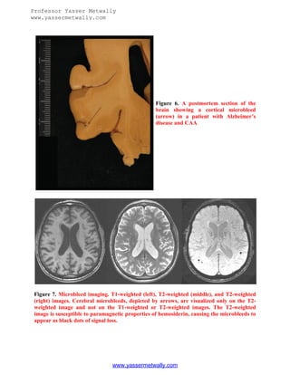 Radiological pathology of cerebral microbleeds | PDF