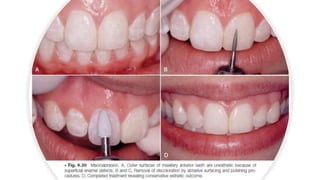 Micro abrasion | PPTX