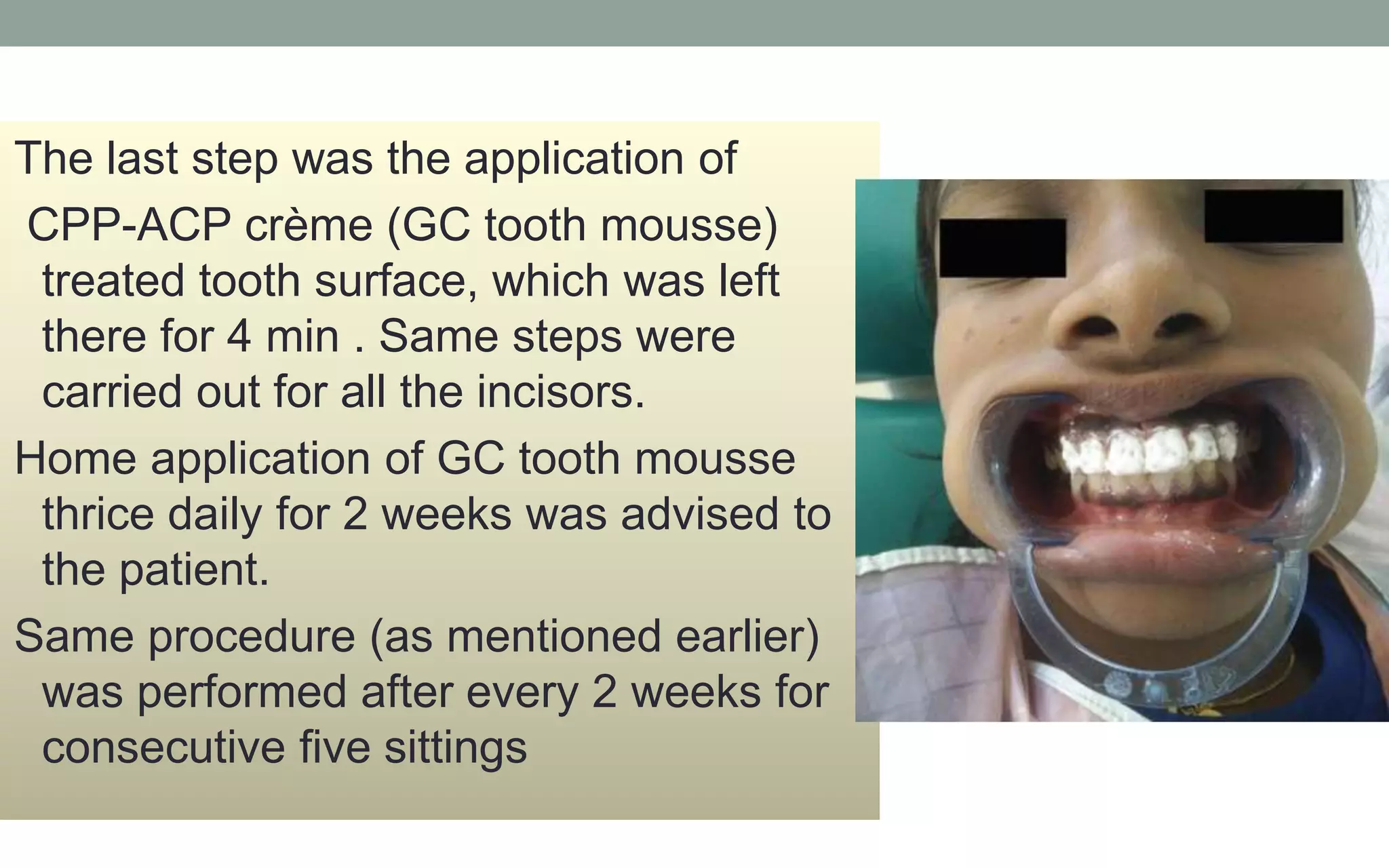 Microabrasion remineralization | PPTX