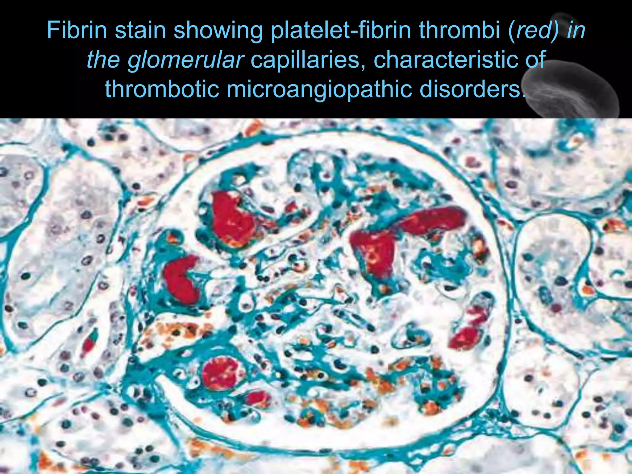 Microangiopathic hemolytic Anemia & Hemolytic Uremic Syndrome | PPTX