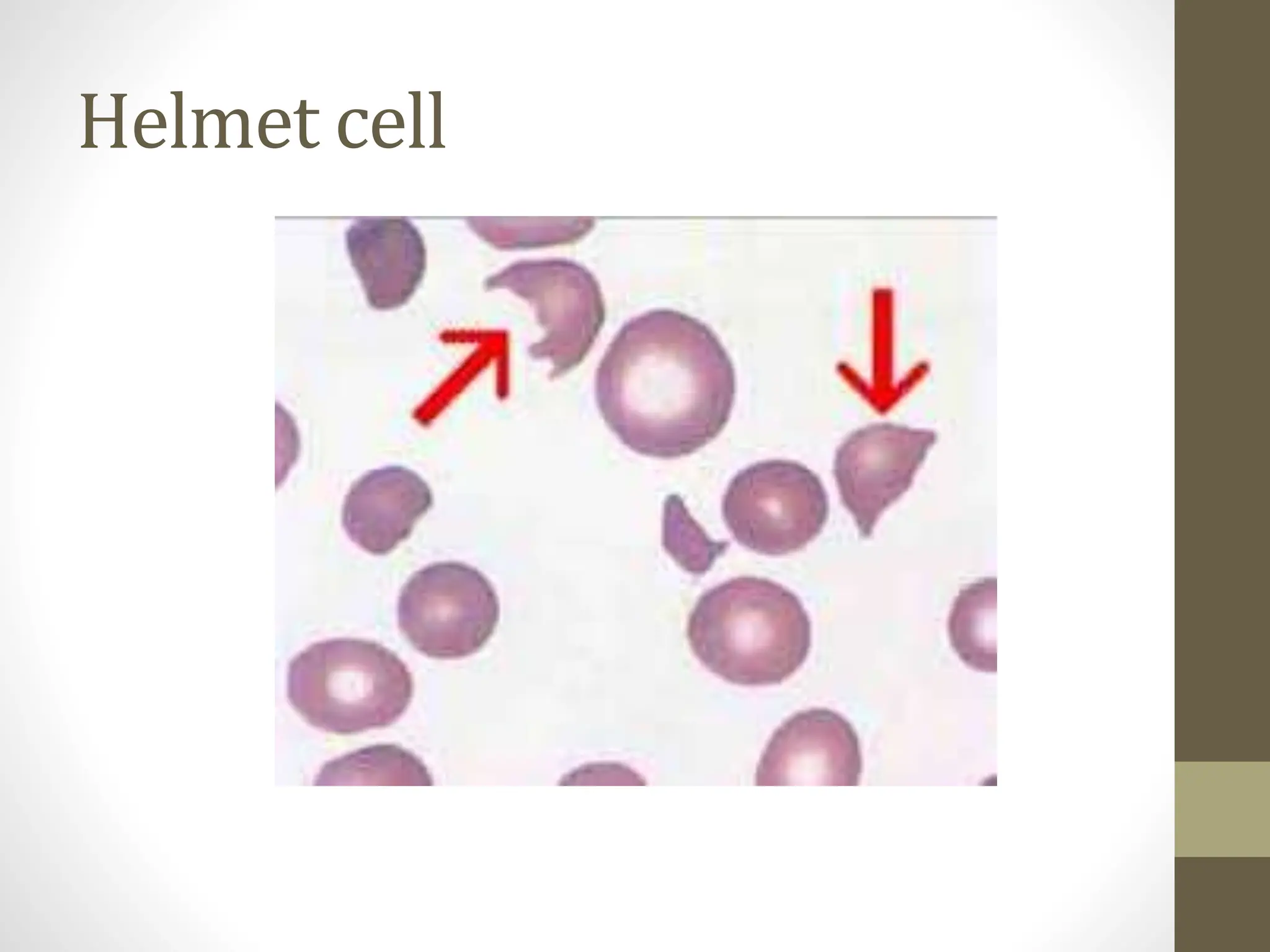 MICROANGIOPATHIC HEMOLYTIC ANEMIA - MAHA.pptx
