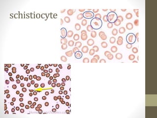 MICROANGIOPATHIC HEMOLYTIC ANEMIA - MAHA.pptx