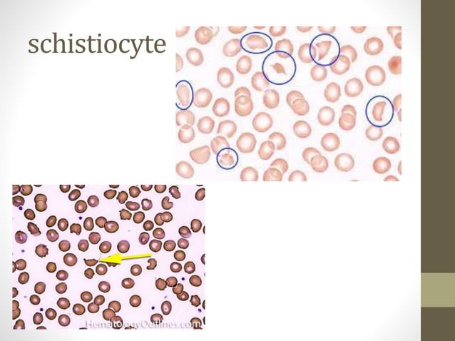 MICROANGIOPATHIC HEMOLYTIC ANEMIA - MAHA.pptx