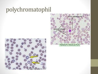 MICROANGIOPATHIC HEMOLYTIC ANEMIA - MAHA.pptx