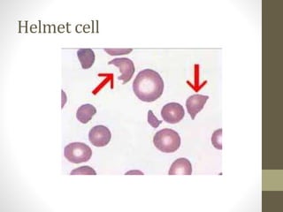 MICROANGIOPATHIC HEMOLYTIC ANEMIA - MAHA.pptx