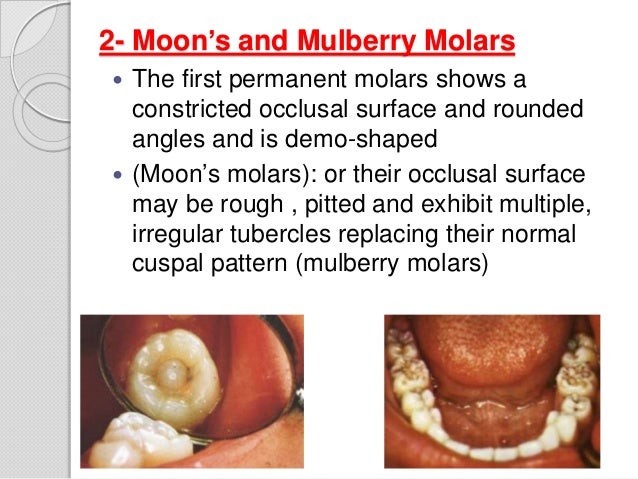 Microbial infections-related-to-oral-cavity