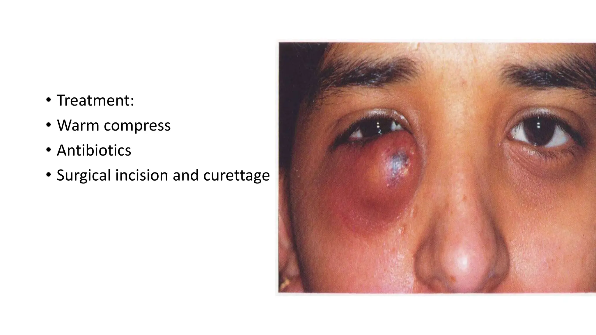 MICROBIAL AND PARASITIC INFECTIONS OF THE EYE.pptx