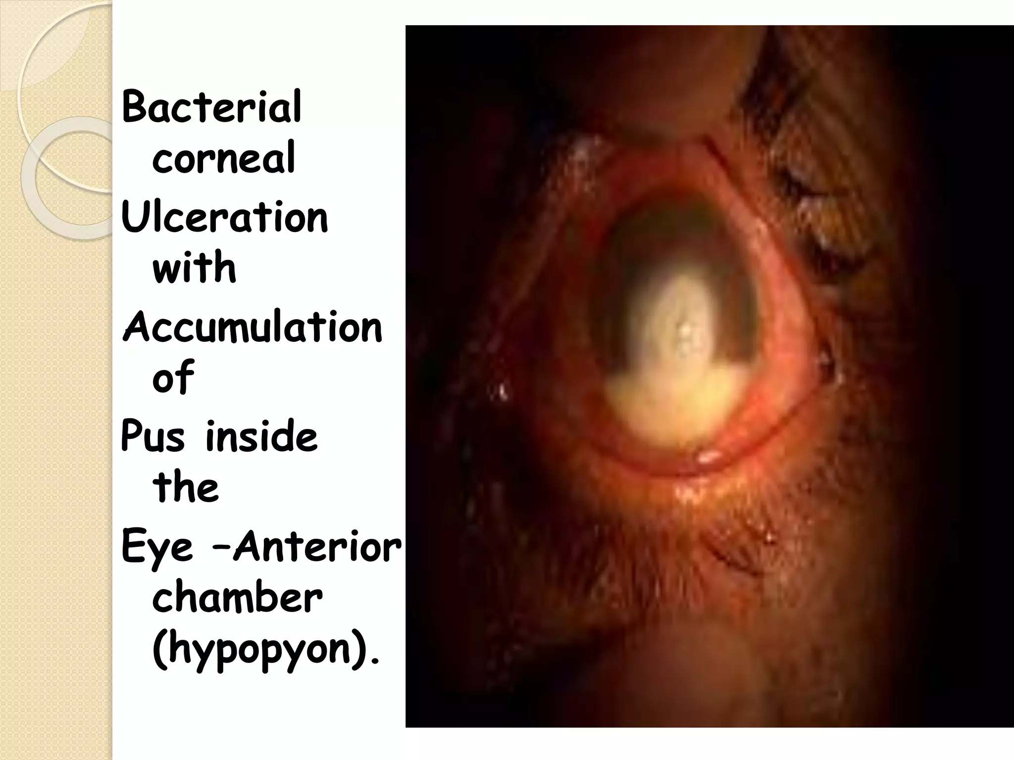 Microbial keratitis | PPTX