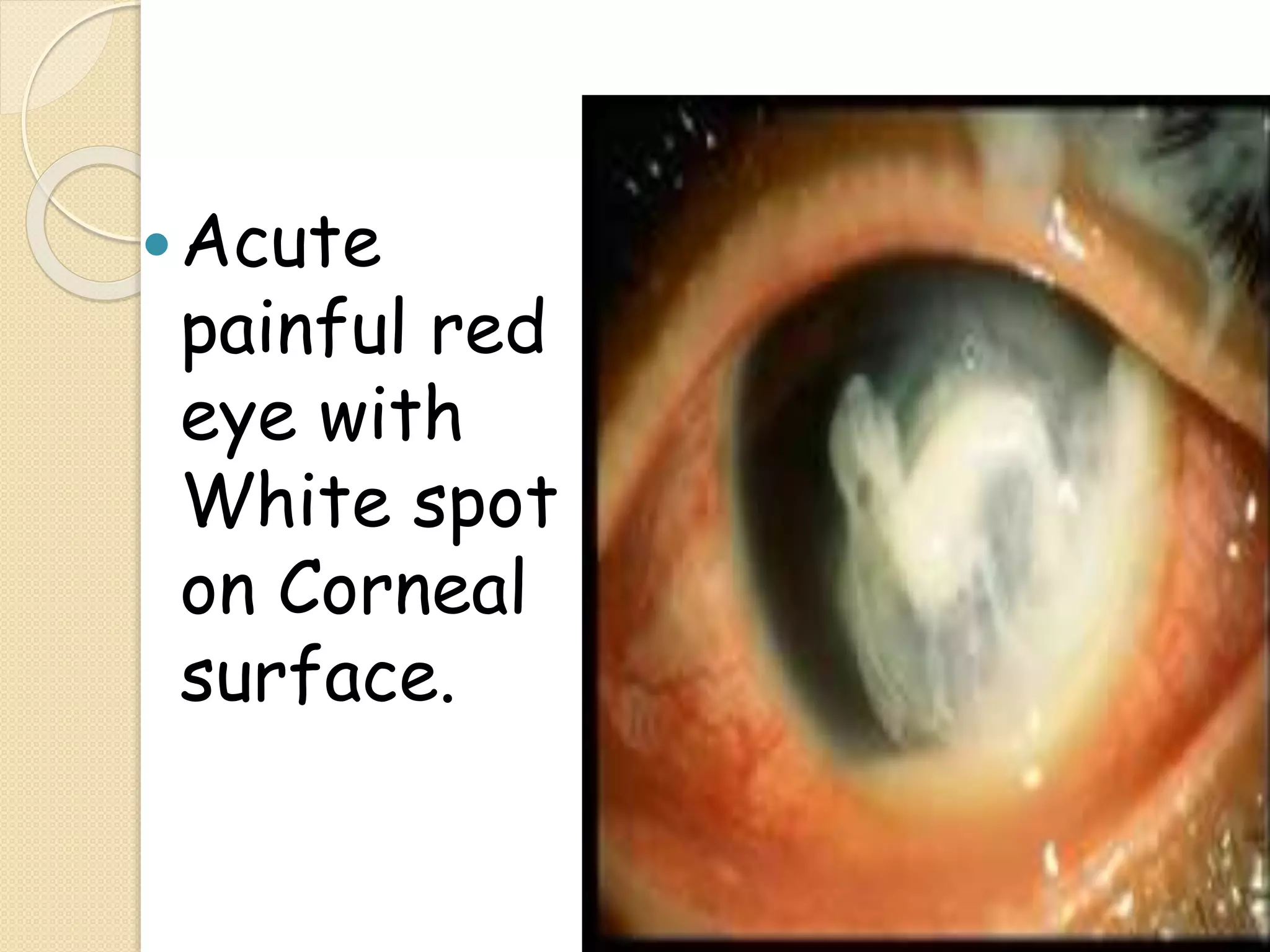 Microbial keratitis | PPTX