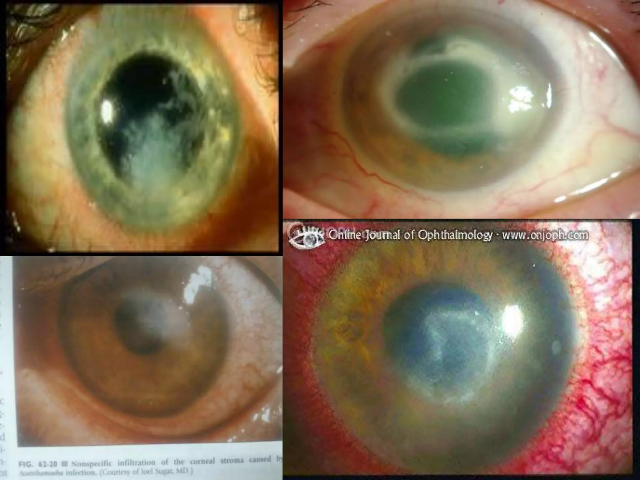 Microbial keratitis | PPTX