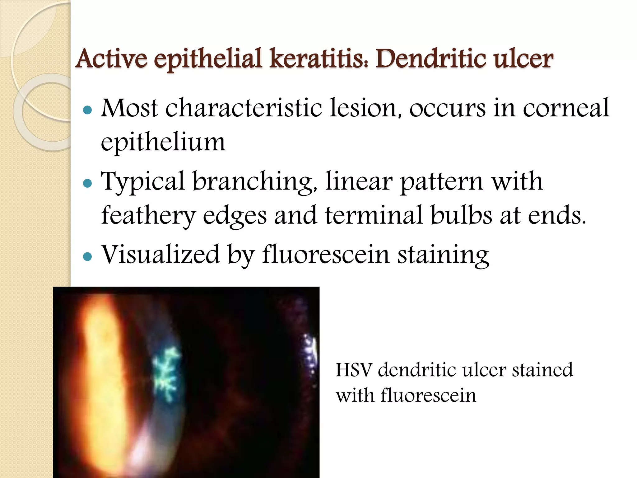 Microbial keratitis | PPTX