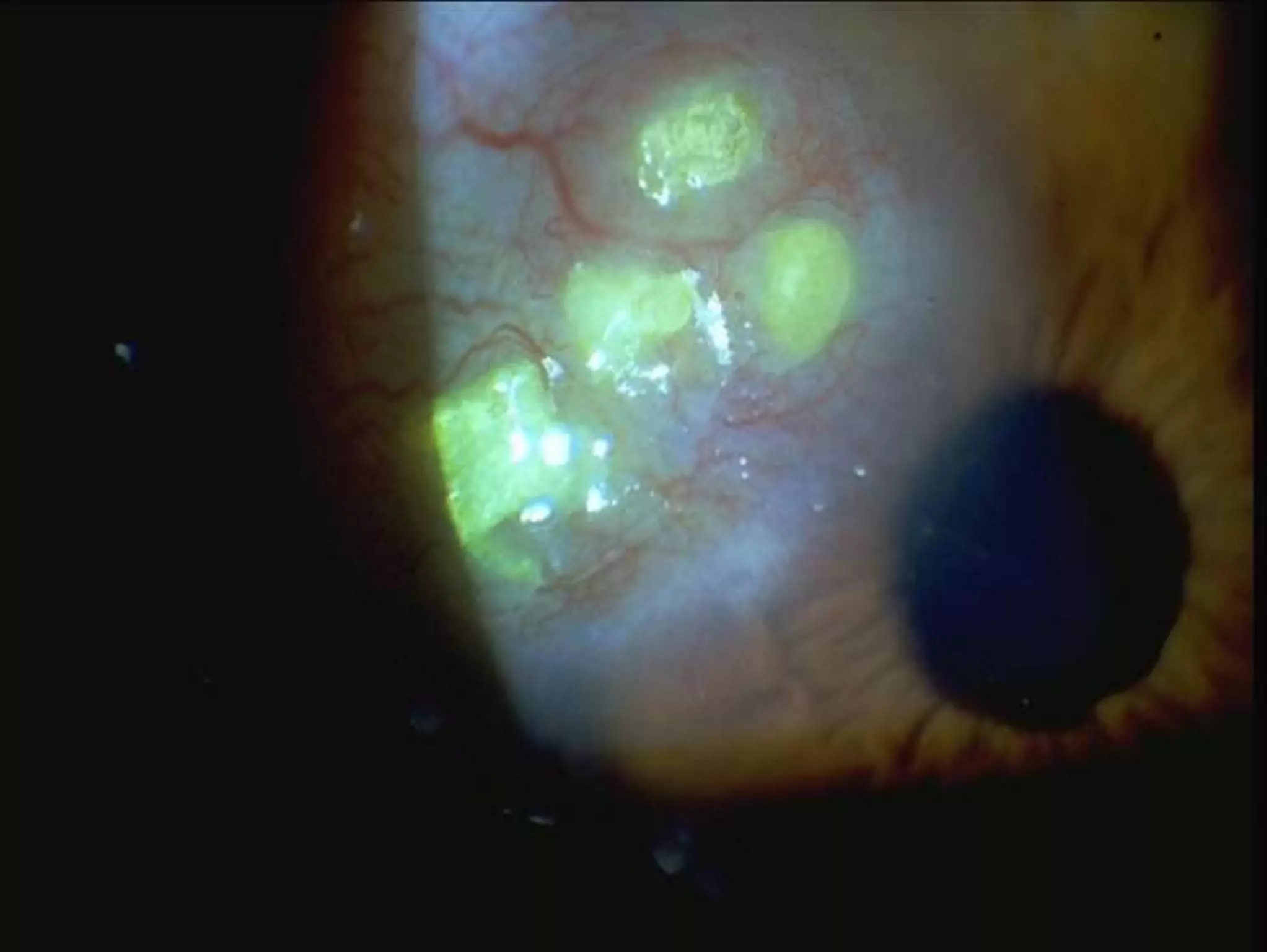 Microbial keratitis | PPTX