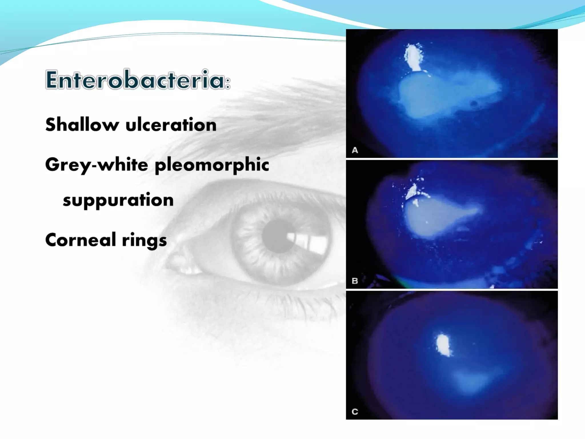 Microbial keratitis | PPT