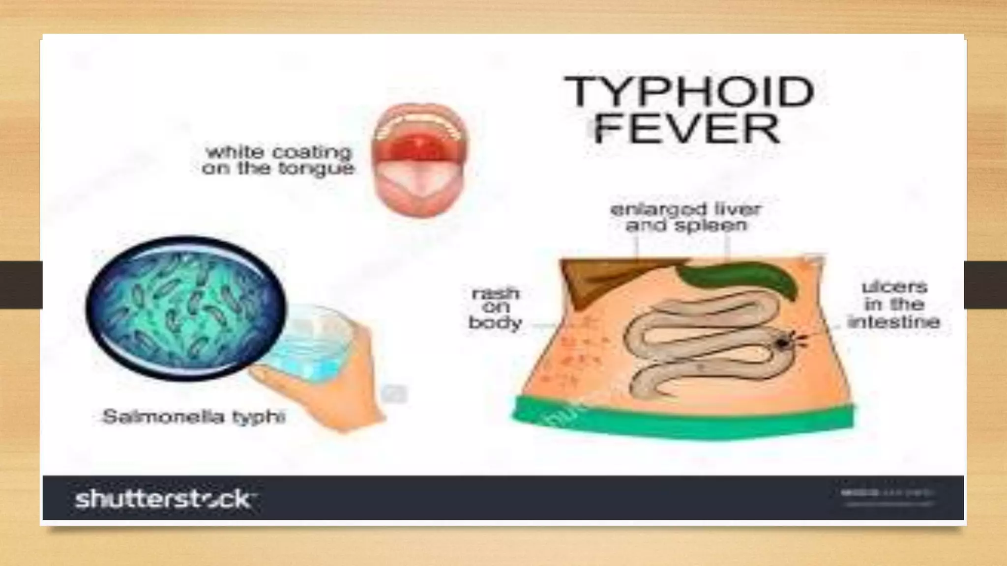 typhoid - enteric fever | PPT