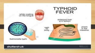 typhoid - enteric fever | PPT