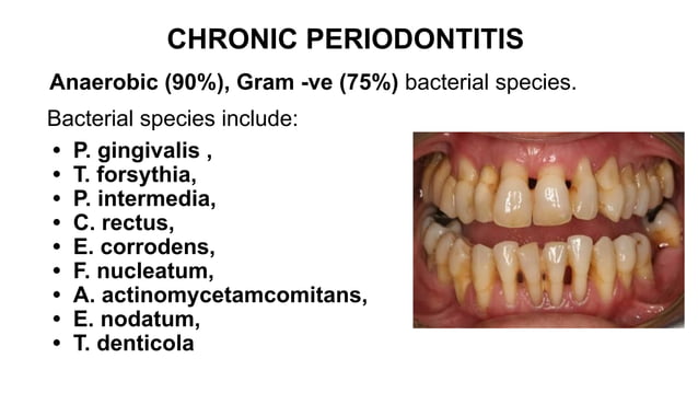 Bacterial Spectrum in Relation to Periodontal Diseases | PPT