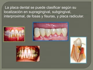 Microbiología de las placas dentales | PPTX