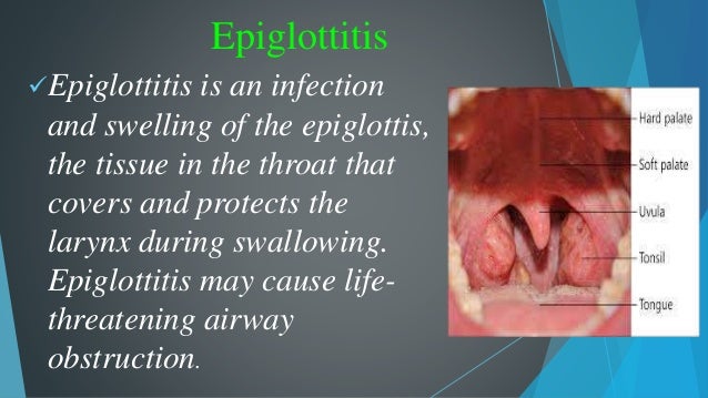 Haemophillous influenza by Dr. Adeel and Dr. Saa Qii