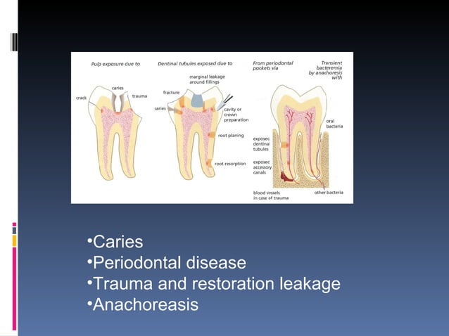 Microbiology aspect in endodontics | PPT | Dental Health | Diseases and ...