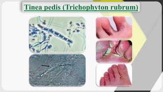 Microbiology (lab diagnosis result of fungal and bacterial skin ...