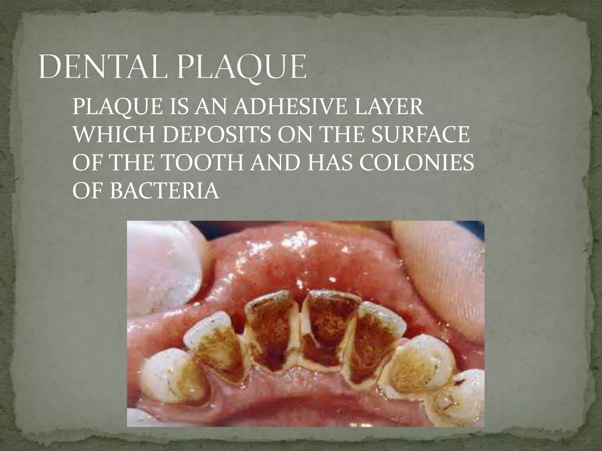 Microbiology of dental caries | PPTX