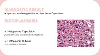 Histoplasmosis | PPTX