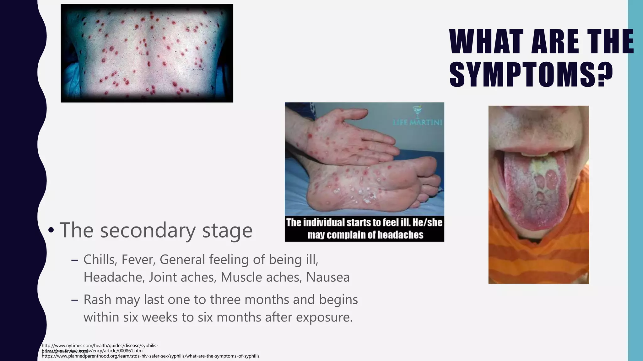 Microbiology syphilis | PPTX