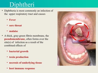MicrobioM4- Bacteria 6. Diphtheria .pptx