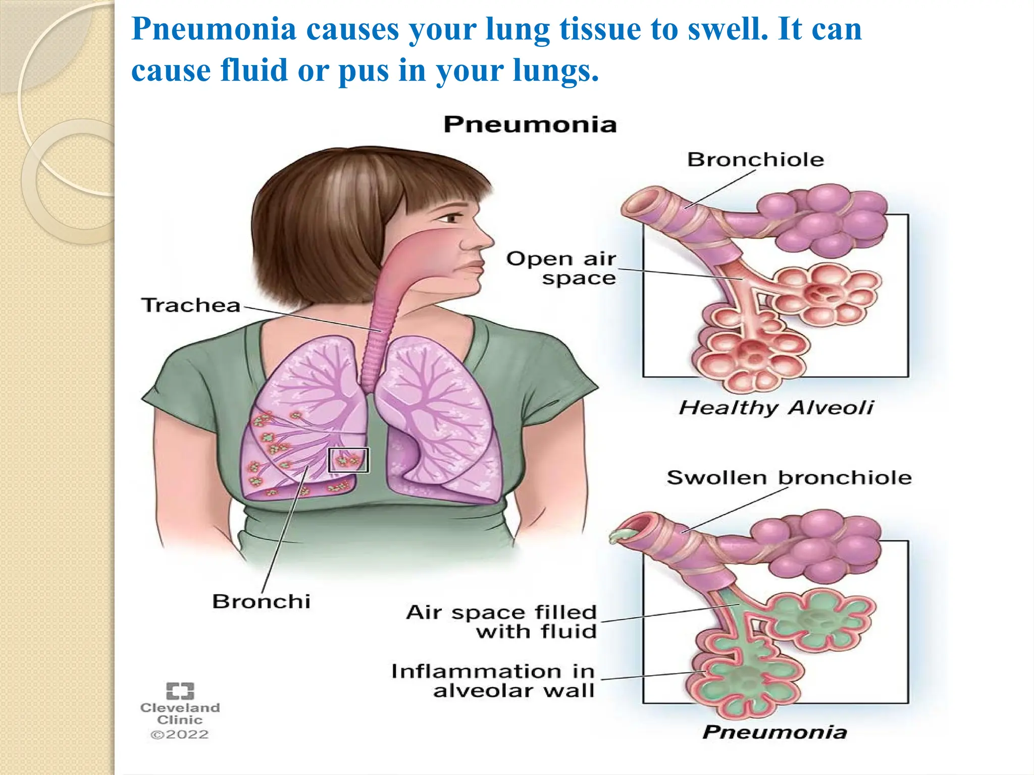 Microbio M5- Bacteria 4. Pneumonia microbiology | PPTX