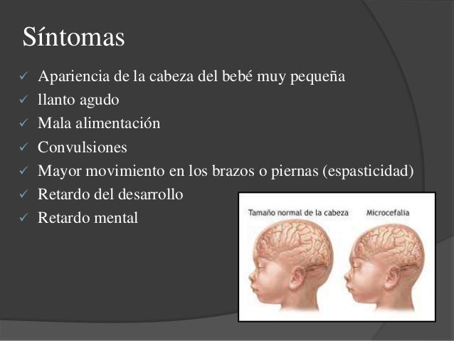 Datos Sobre La Microcefalia – PING