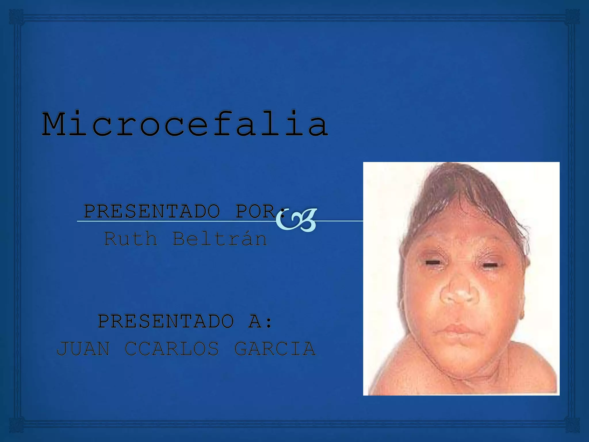 Microcefalia | PPTX