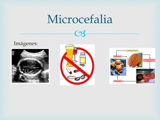 Microcefalia | PPTX