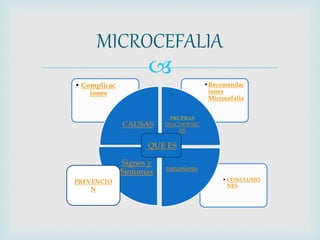Microcefalia | PPTX